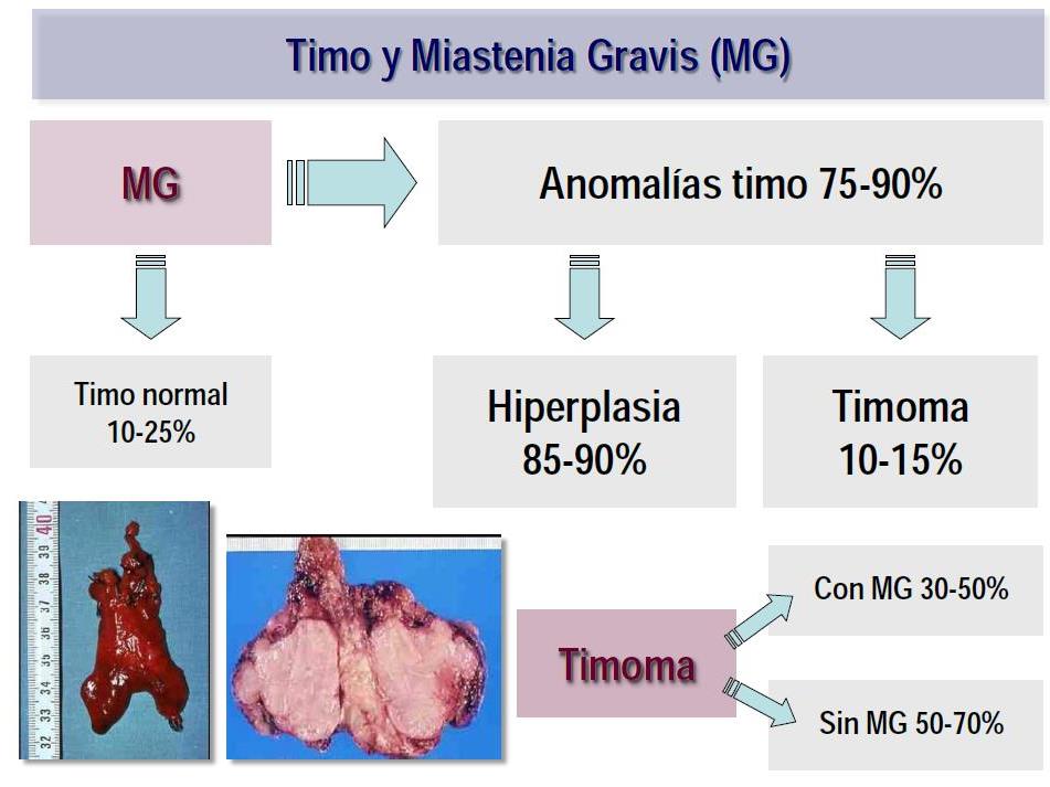 MIASTENIA GRAVIS: TRATAMIENTO – Timectomía (extirpación de la glándula ...